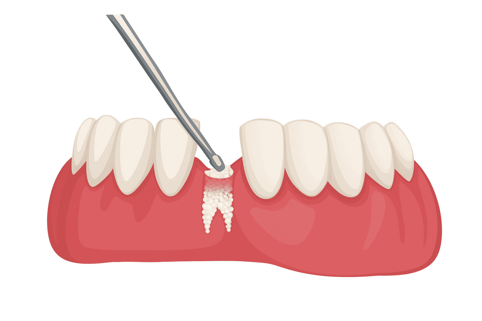 Dental Bone Grafts Explained: What It Is, Why It’s Done, and What to ...